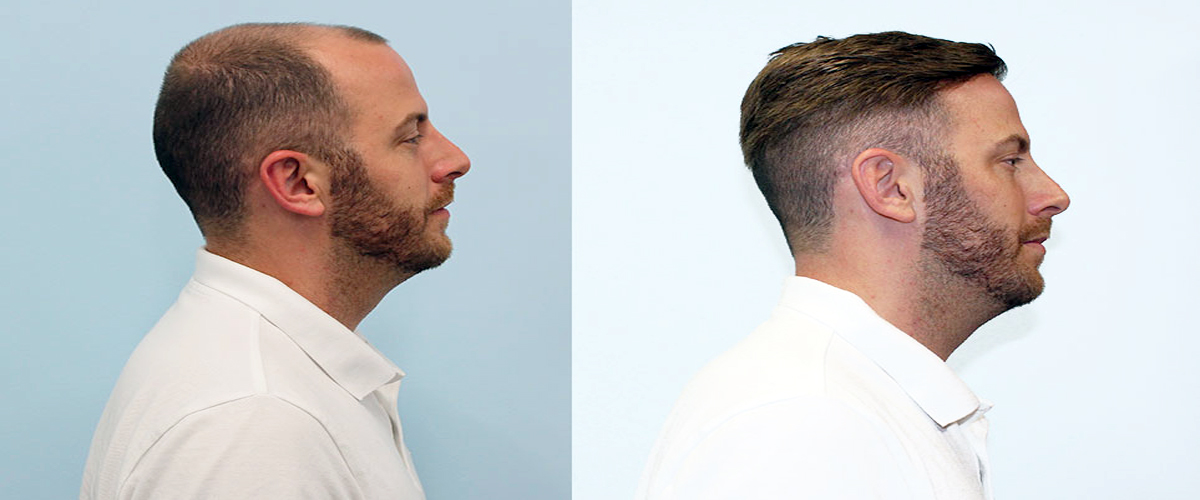 Thin Skin Toupee VS Full Lace Hair System - Blog